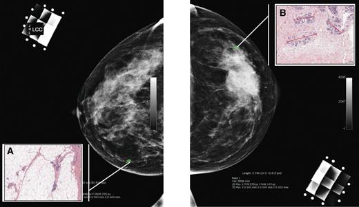 Relationship of Terminal Duct Lobular Unit Involution of the Breast ...