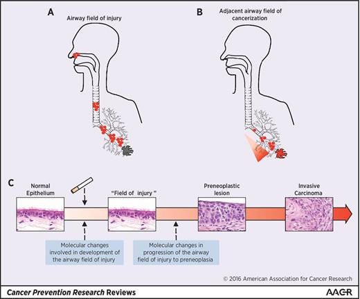 Early Events in the Molecular Pathogenesis of Lung Cancer | Cancer ...