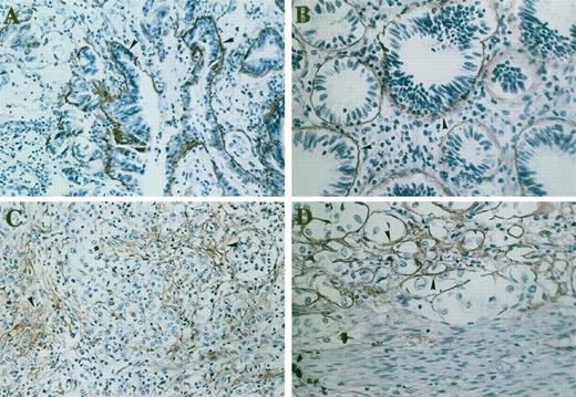 Overexpression Of Laminin γ2 Chain Monomer In Invading Gastric