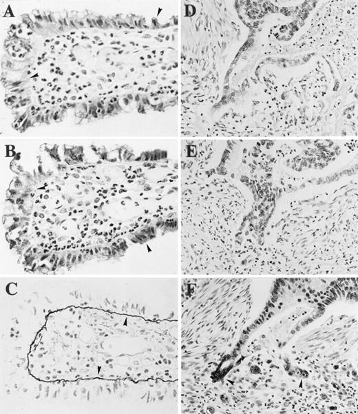 Overexpression Of Laminin γ2 Chain Monomer In Invading Gastric