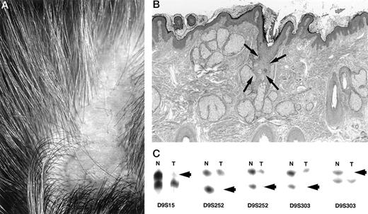 The Sebaceous Nevus | Cancer Research | American Association for Cancer ...