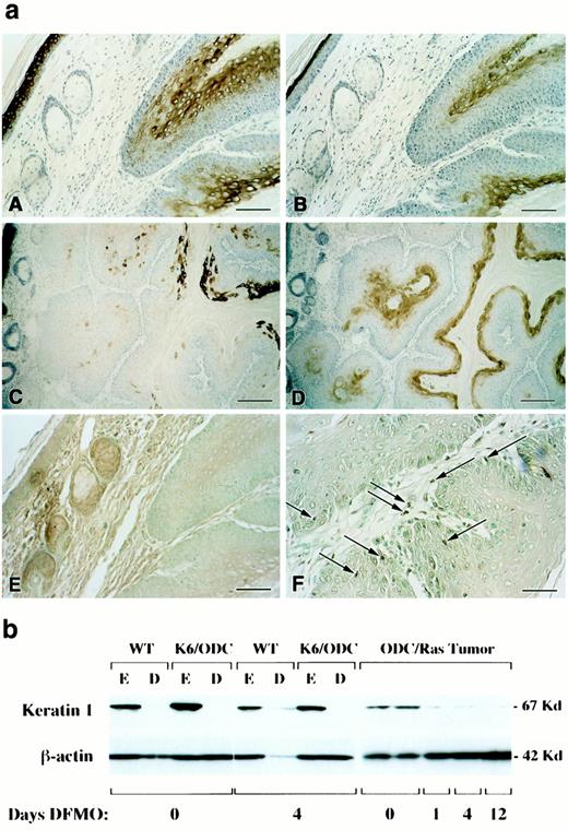 Inhibition of Ornithine Decarboxylase (ODC) Decreases Tumor ...