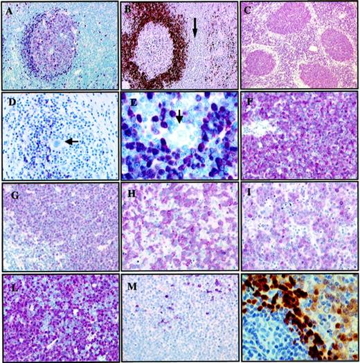 Regulation of TCL1 Expression in B- and T-Cell Lymphomas and Reactive ...