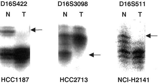 Loss of Expression and Aberrant Methylation of the CDH13 (H-Cadherin ...