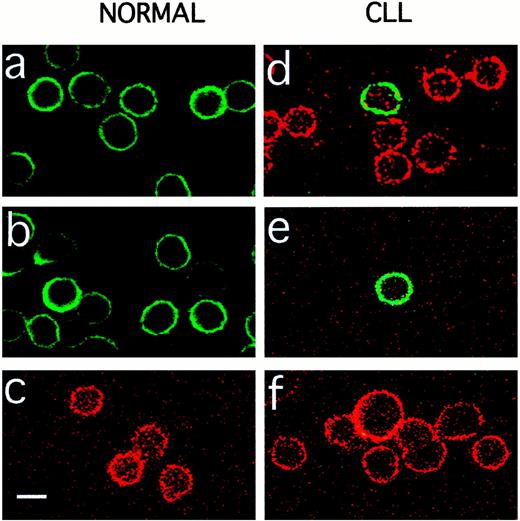 Immunophenotyping of Leukemias Using a Cluster of Differentiation ...