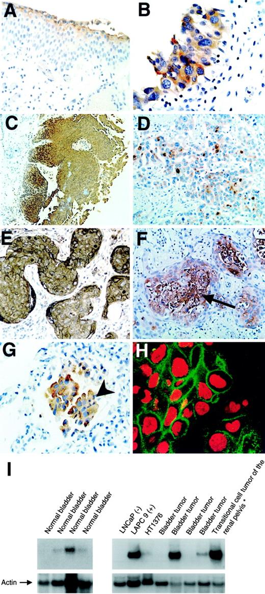 Prostate Stem Cell Antigen Is Overexpressed in Human Transitional Cell ...