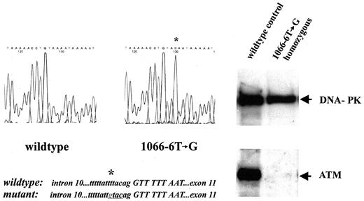 Spectrum of ATM Gene Mutations in a Hospital-based Series of Unselected ...