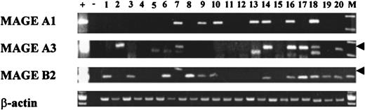 Activation of Melanoma Antigen Tumor Antigens Occurs Early in Lung ...