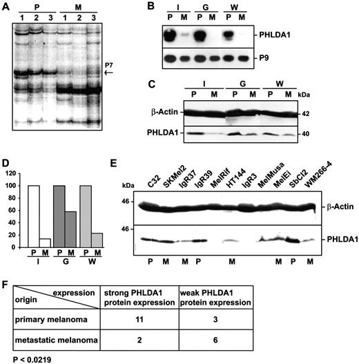 Identification of the Human PHLDA1/TDAG51 Gene | Cancer Research ...