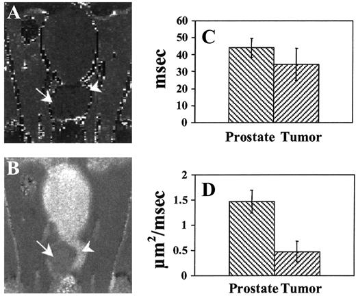Improved Magnetic Resonance Imaging Detection of Prostate Cancer in a ...