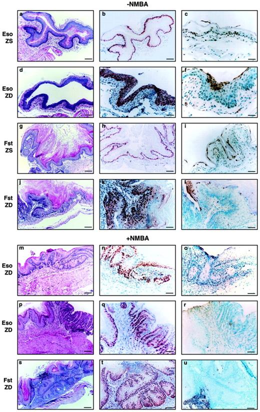 p53 Deficiency Accelerates Induction and Progression of Esophageal and ...