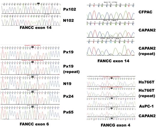Fanconi Anemia Gene Mutations in Young-onset Pancreatic Cancer1 ...