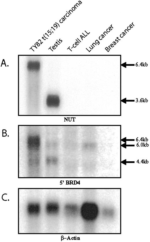 BRD4-NUT Fusion Oncogene | Cancer Research | American Association for ...
