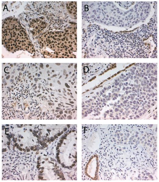 Loss of BRG1/BRM in Human Lung Cancer Cell Lines and Primary Lung ...
