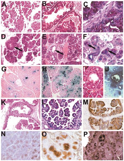 Preinvasive Pancreatic Neoplasia of Ductal Phenotype Induced by Acinar ...