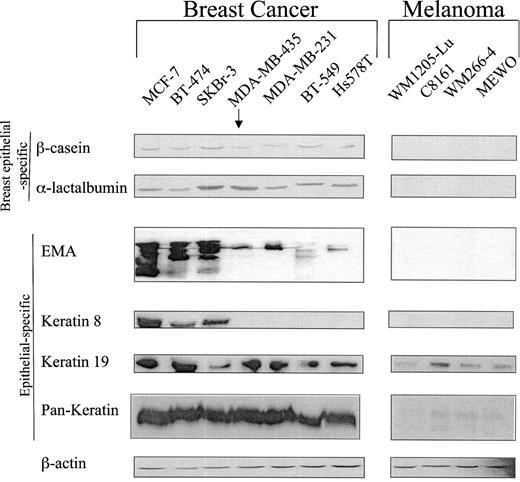 Lineage Infidelity of MDA-MB-435 Cells | Cancer Research | American ...