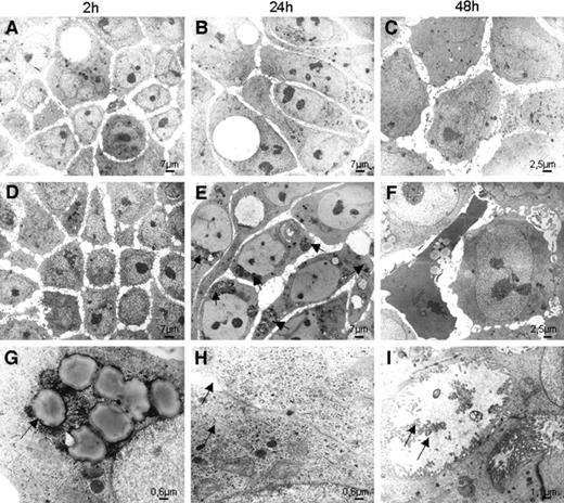Lipoptosis | Cancer Research | American Association for Cancer Research
