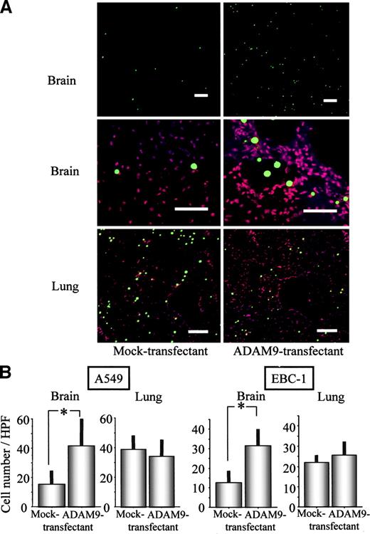 Overexpression of ADAM9 in Non-Small Cell Lung Cancer Correlates with ...