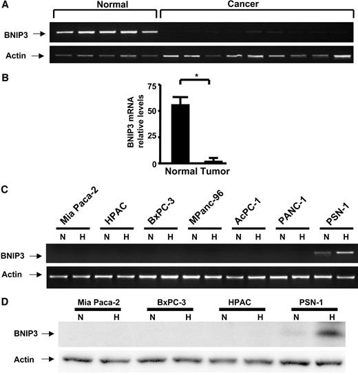 Silencing of the Hypoxia-Inducible Cell Death Protein BNIP3 in ...