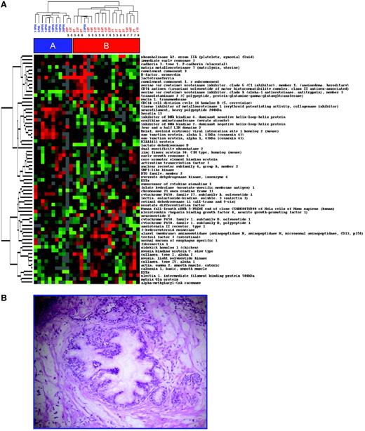 Molecular Features of the Transition from Prostatic Intraepithelial ...