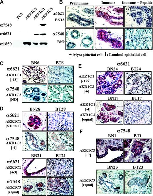 Selective Loss of AKR1C1 and AKR1C2 in Breast Cancer and Their ...