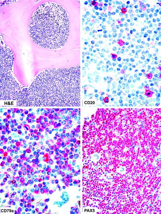 PAX5 Expression in Acute Leukemias | Cancer Research | American ...