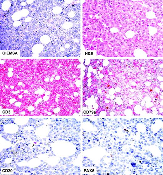 PAX5 Expression in Acute Leukemias | Cancer Research | American ...