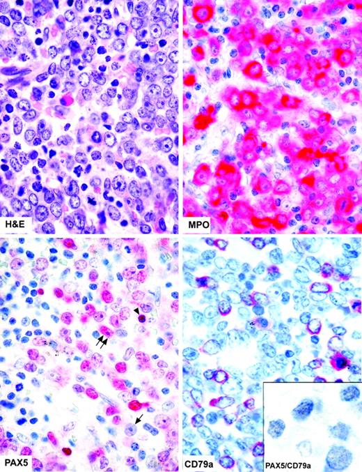 PAX5 Expression in Acute Leukemias | Cancer Research | American ...