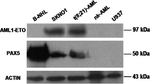 PAX5 Expression in Acute Leukemias | Cancer Research | American ...