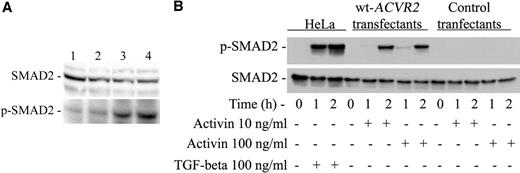 Activin Type II Receptor Restoration in ACVR2-Deficient Colon Cancer ...