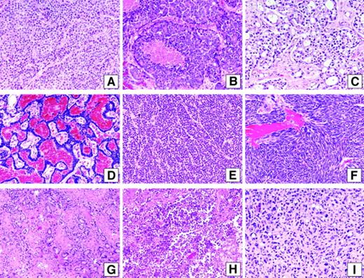 Androgen-Independent Prostate Cancer Is a Heterogeneous Group of ...