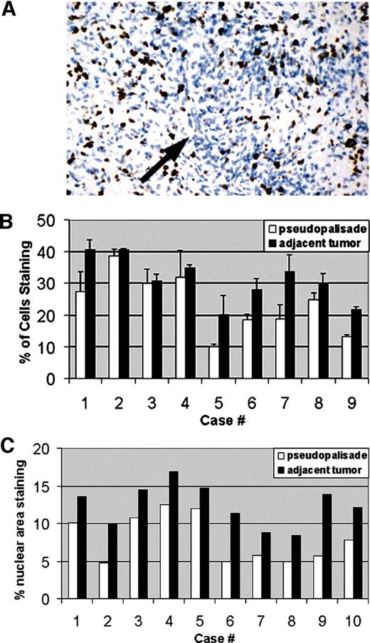 Pseudopalisades in Glioblastoma Are Hypoxic, Express Extracellular ...