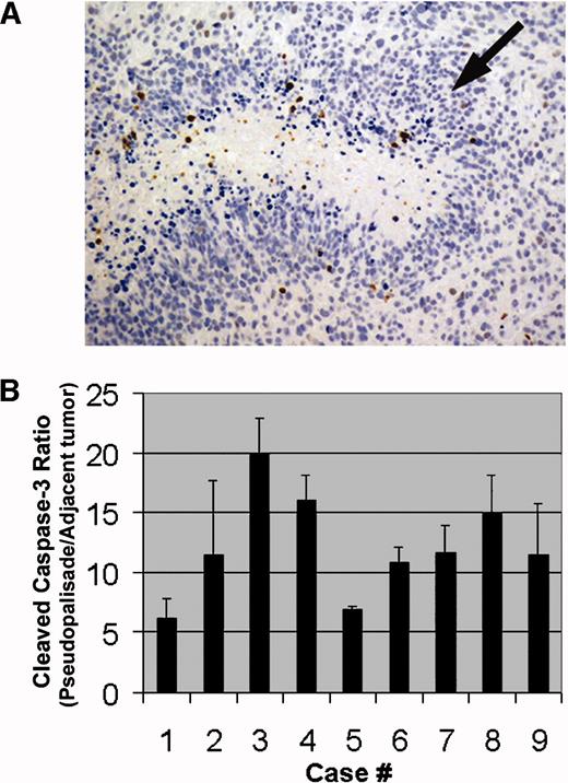 Pseudopalisades in Glioblastoma Are Hypoxic, Express Extracellular ...