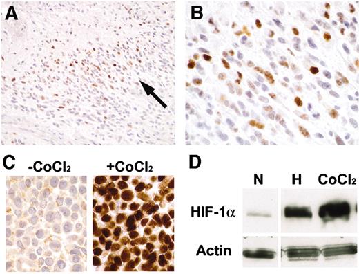 Pseudopalisades in Glioblastoma Are Hypoxic, Express Extracellular ...