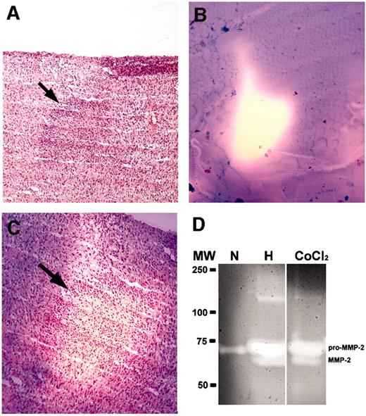 Pseudopalisades in Glioblastoma Are Hypoxic, Express Extracellular ...
