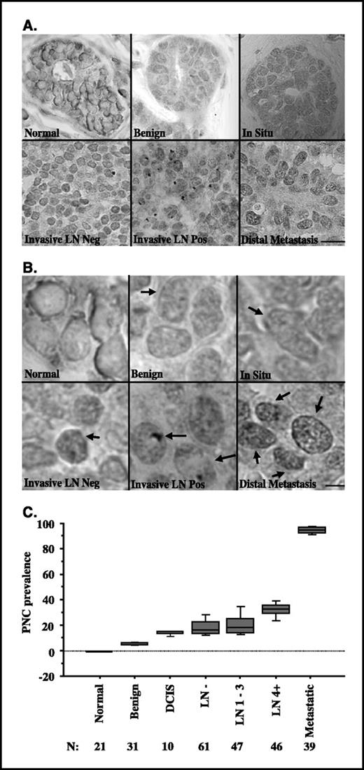 Perinucleolar Compartment Prevalence Has an Independent Prognostic ...