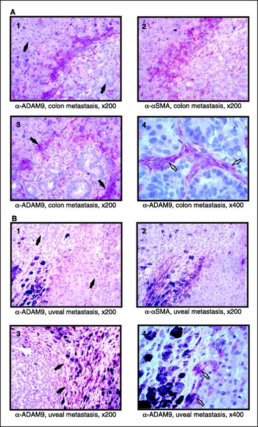 A Secreted Form of ADAM9 Promotes Carcinoma Invasion through Tumor ...