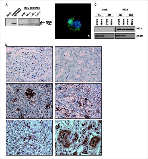 Hypoxia-Inducible Protein 2 (HIG2), a Novel Diagnostic Marker for Renal ...