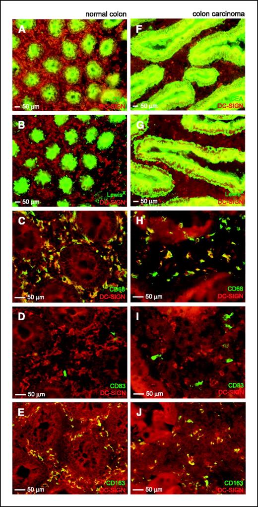 Dendritic Cells Recognize Tumor-Specific Glycosylation of ...