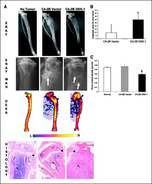 Prostate Cancer Cells Promote Osteoblastic Bone Metastases through Wnts ...