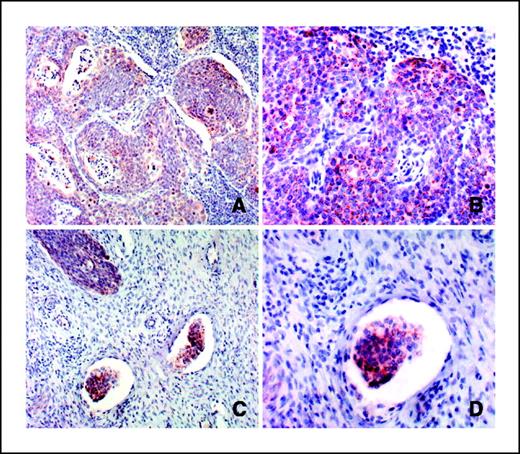 Overexpression of LAMP3/TSC403/DC-LAMP Promotes Metastasis in Uterine ...