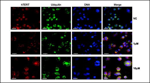 The G-Quadruplex-Interactive Molecule BRACO-19 Inhibits Tumor Growth ...