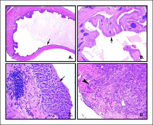 Transitional Cell Hyperplasia and Carcinomas in Urinary Bladders of ...