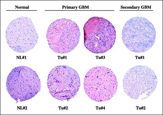 Distinct Transcription Profiles of Primary and Secondary Glioblastoma ...