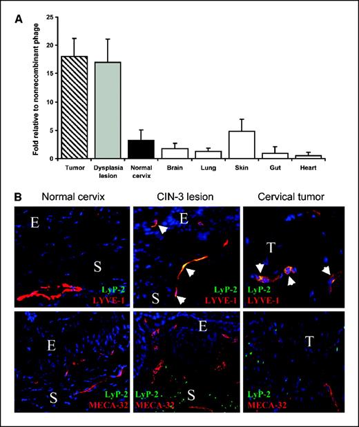 Lymphatic Zip Codes in Premalignant Lesions and Tumors | Cancer ...