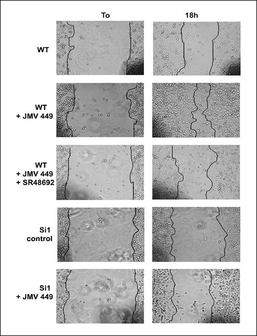 Expression of Neurotensin and NT1 Receptor in Human Breast Cancer: A ...