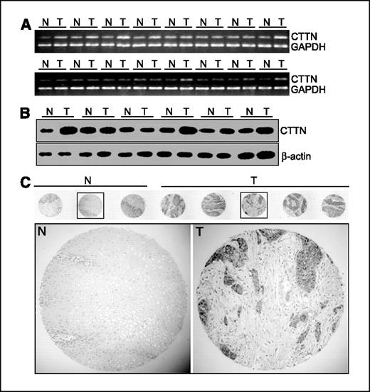 Amplification and Overexpression of CTTN (EMS1) Contribute to the ...