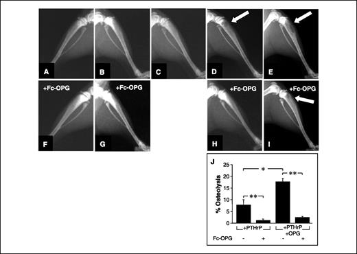 Osteoprotegerin Overexpression by Breast Cancer Cells Enhances ...