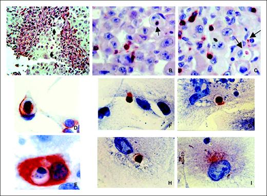 Cannibalism of Live Lymphocytes by Human Metastatic but Not Primary ...