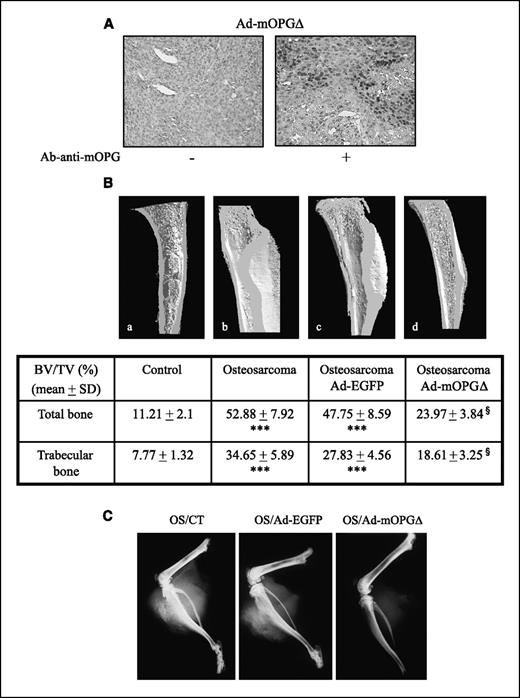 Therapeutic Relevance of Osteoprotegerin Gene Therapy in Osteosarcoma ...